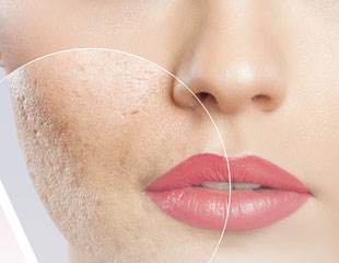 Fade and Fill Scars by Laser Technology at FV Skin & Laser Clinic