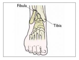 Pilon fracture - FV Magazine