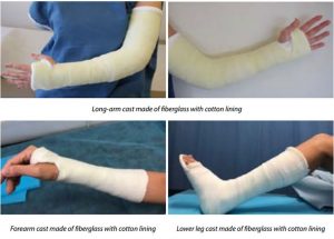 Care of Casts and Splints - FV Magazine
