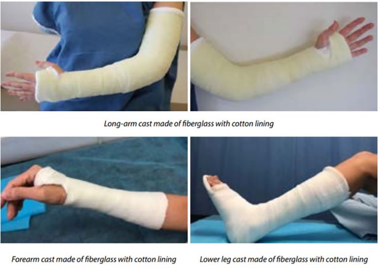 Care of Casts and Splints - FV Magazine