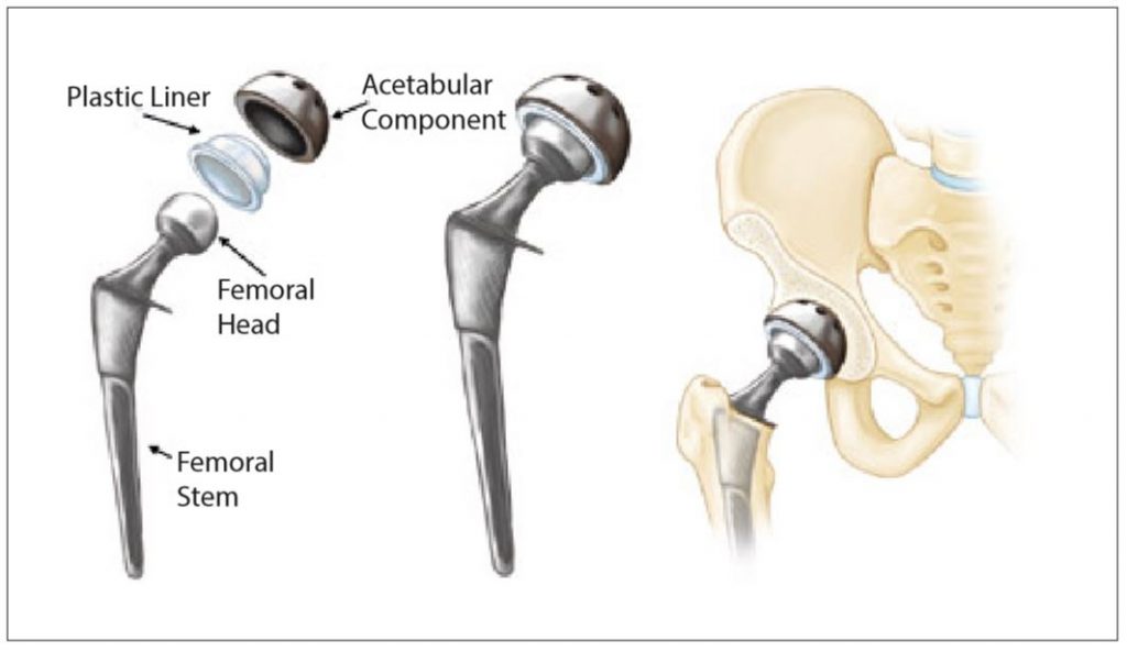 Hip Replacement - FV Magazine