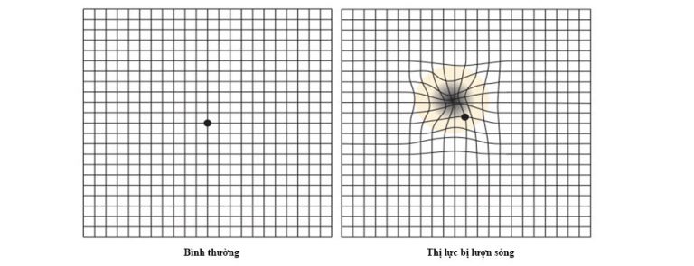 Age-Related Macular Degeneration - FV Magazine
