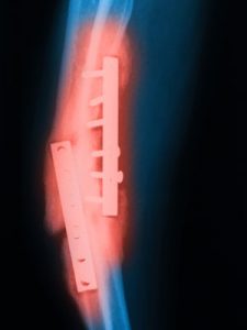 Infection after fracture - FV Magazine