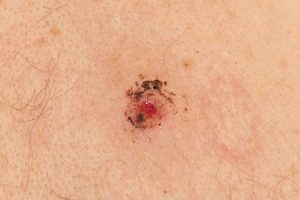 Skin Lesion Removal - FV Magazine