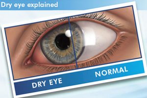 Dry Eye - FV Magazine
