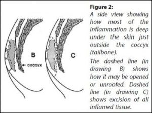 Pilonidal disease - FV Magazine