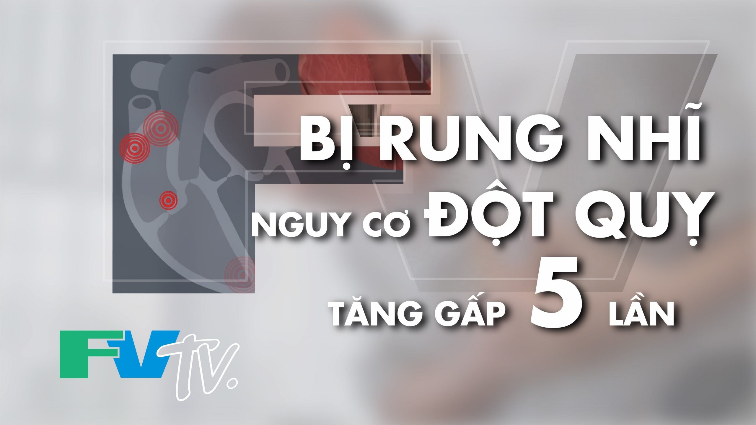 Treatment Of Atrial Fibrillation With Radio Frequency Ablation At Fv