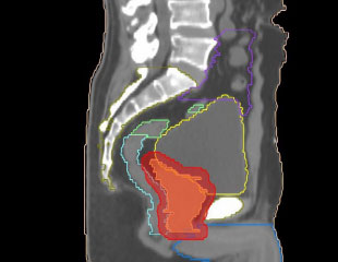 Bowel and Bladder Preparation for Radiotherapy to the Pelvis - FV Magazine