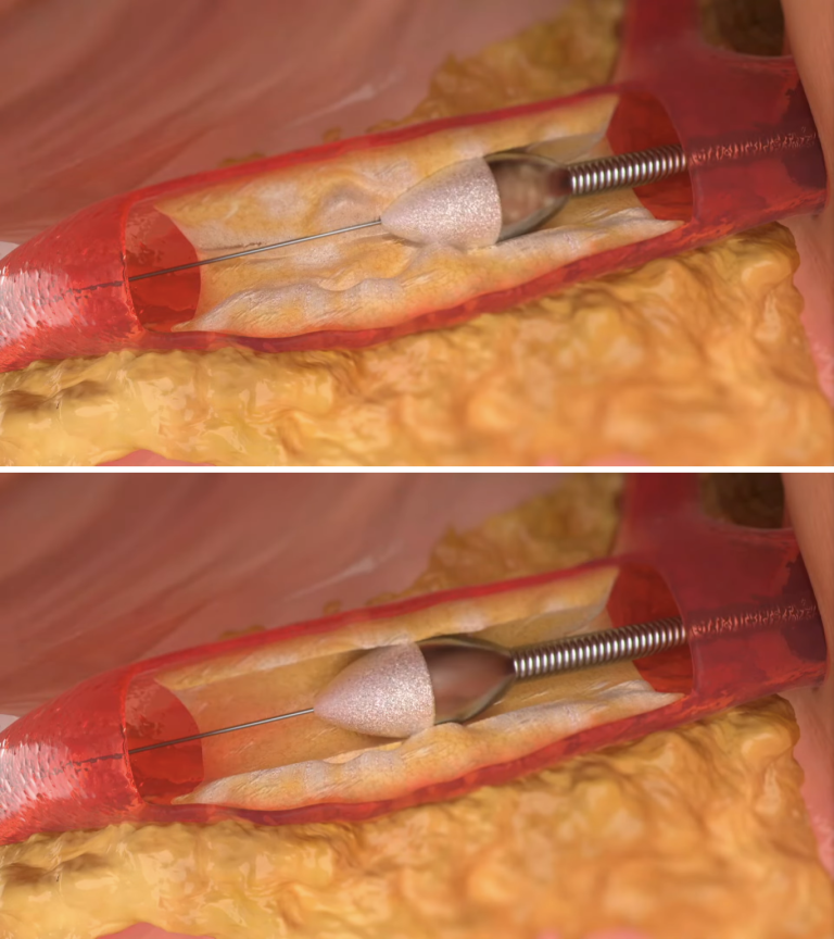 FV HOSPITAL USES DIAMOND DRILL TO TREAT CALCIFIED CORONARY ARTERY FOR ...